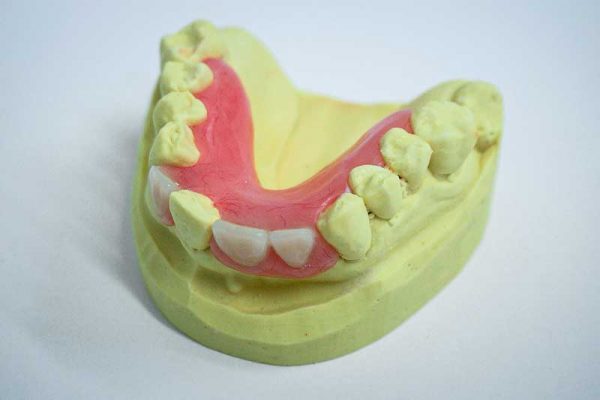 Flexible Dentures Tweed Heads | Affordable, Custom Flexible Dentures