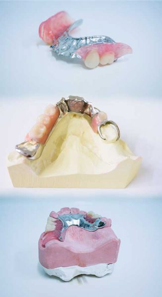 Chrome Dentures Tweed Heads | Affordable, Custom Metal Dentures